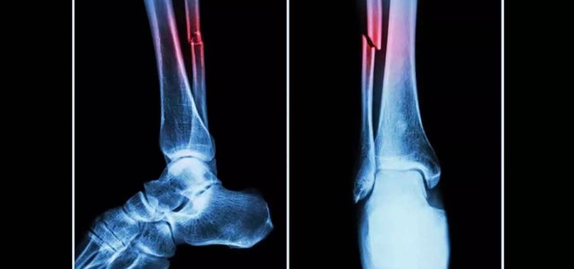 Automated Algorithm May Detect Heart Fracture Risks In Routine Bone Scans